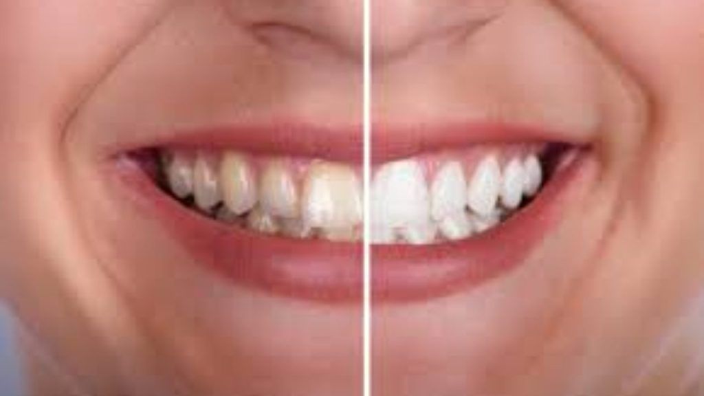 Denti gialli | Torna a sorridere senza imbarazzo: la soluzione a casa tua